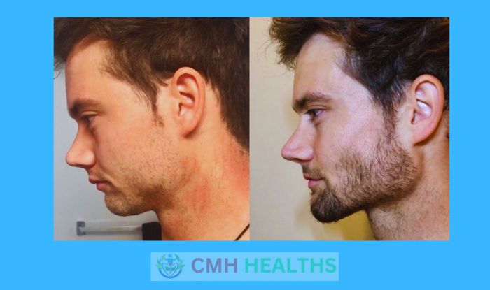 How to Mew properly step by step guide - CMH HEALTHS