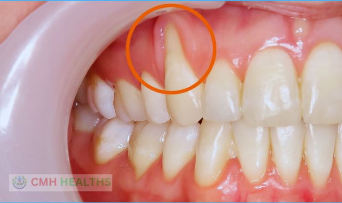 What do receding gums look like | Treatment guideline - CMH HEALTHS